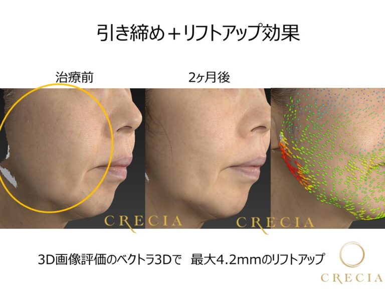 オリジオrf(オリジオx オリジオ) 葛飾区の美容皮膚科:クレシアスキンケアクリニック