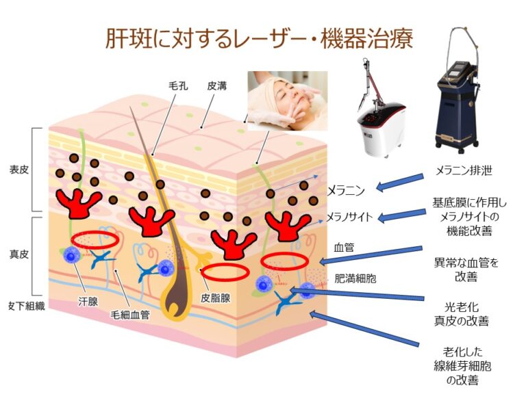 肝斑・くすみにお悩みの方へ 葛飾区の美容皮膚科:クレシアスキンケアクリニック